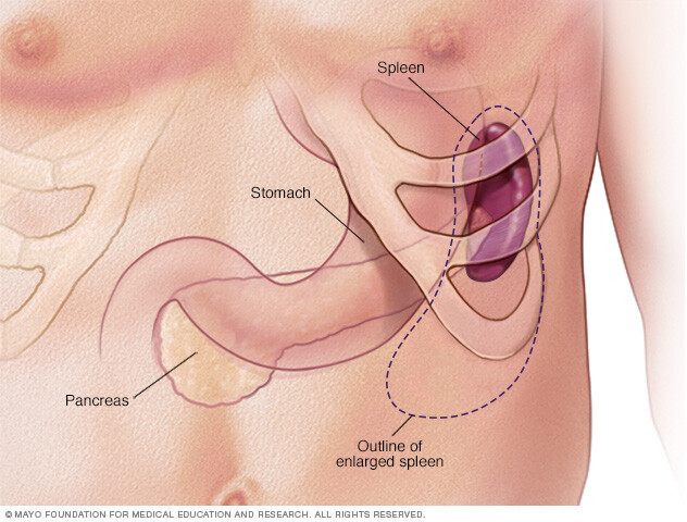 Enlarged spleen (splenomegaly)